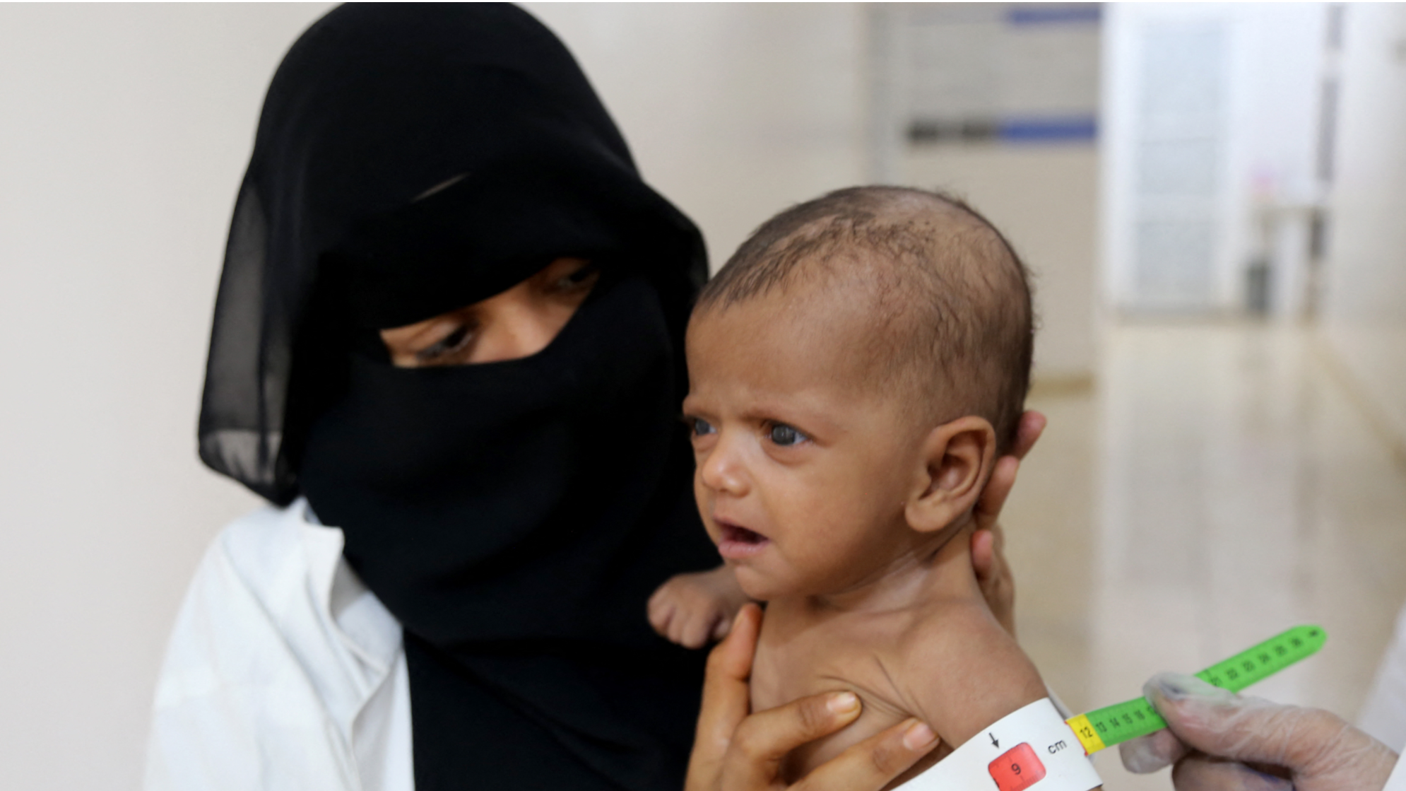 MSF: Malnutrition is 'crisis inside the crisis' in Yemen